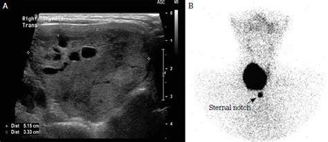 Racgp Thyroid Scans