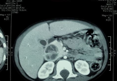 Reporte De Caso Rabdomiosarcoma Botrioides De La Vía Biliar Imagen
