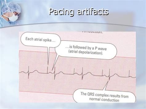 Temporary Pacemaker Slides