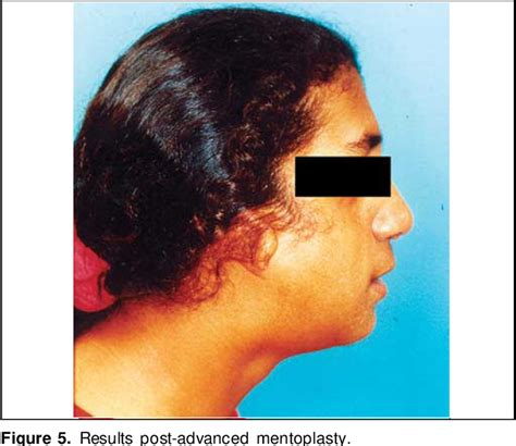Pdf Treacher Collins Syndrome With Choanal Atresia A Case Report And