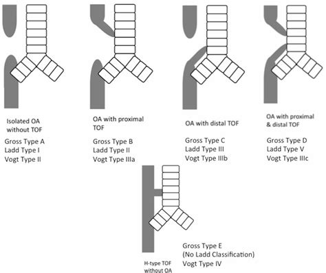 Newly Discovered Variant Of Oesophageal Atresia ‘type Y Bmj Case