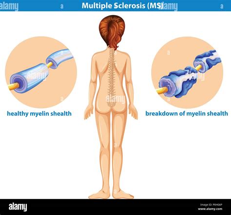 A Medical Vector Of Multiple Sclerosis Illustration Stock Vector Image