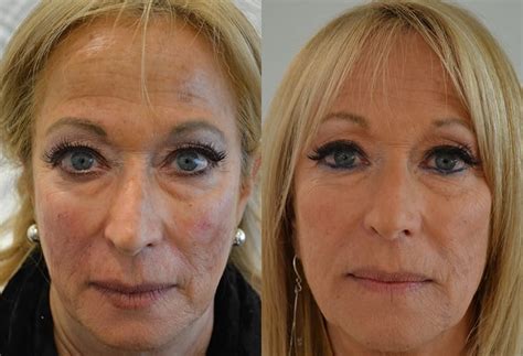 Best Dermal Filler Injection Expert For Facial Chin And More