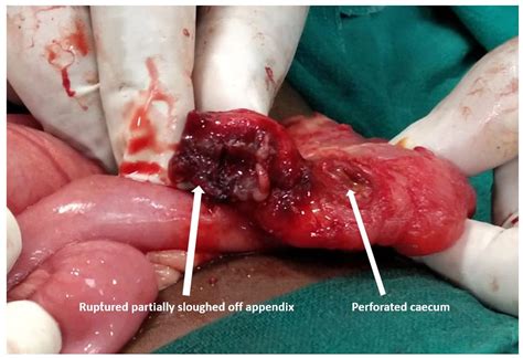 Clinical Photograph Showing Ruptured Appendix With A Caecal Perforation