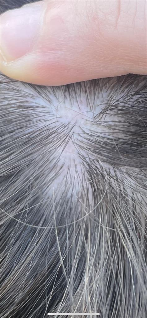 Scarring Hair Loss Community