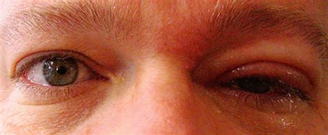 Shingles In Eyes Contagious Doctorvisit