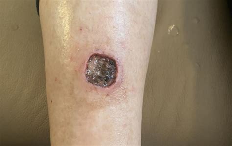 What Do Leg Ulcers Look Like Usa Vein Clinics