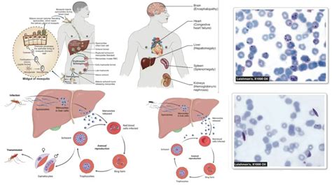 Malaria Parasite Life Cycle Pathogenesis Diagnosis Treatment