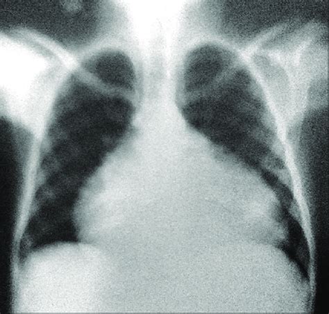 Chest X Ray Showing Cardiomegaly Download Scientific Diagram