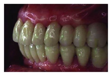 Coincidence Between Centric Occlusion And Maximum Intercuspation And Download Scientific