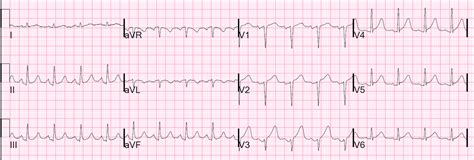 Dr Smiths Ecg Blog Copd Exacerbation What Do The Ecg And Bedside