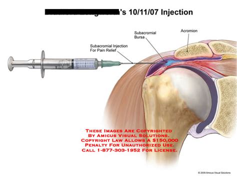 AMICUS Illustration Of Amicus Surgery Injection Rotator Cuff Tear