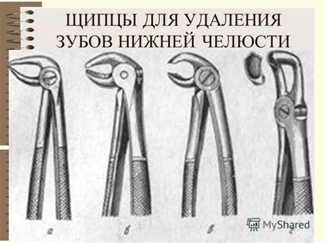 Щипцы Для Удаления Зубов Фото — Mixyfotos.ru