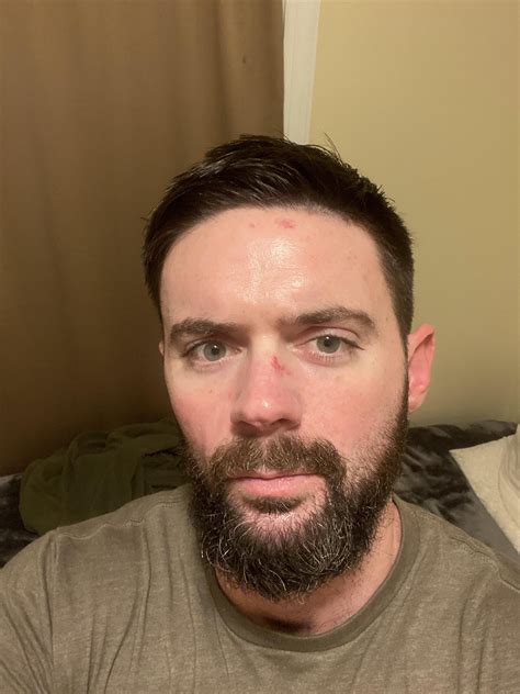 Day After Pdl Treatment R Rosacea