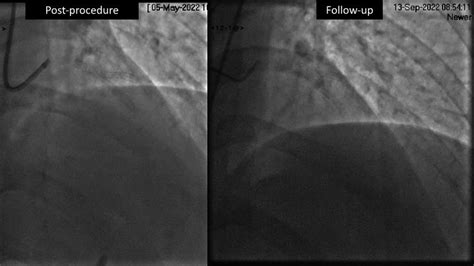 Sirolimus Coated Balloon Expanding The Scope Of Coronary Artery