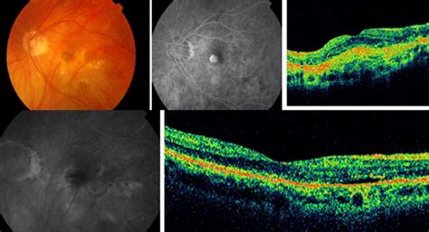 Top Myopic Cnvm Pre Injection Left Colored Fundus Middle Ffa And