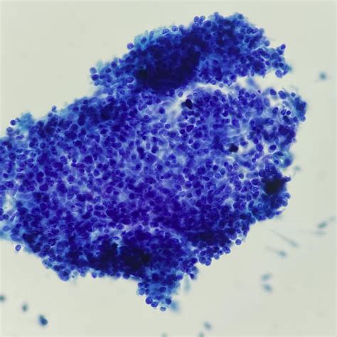 Thyroid Fna ~50yo F Rcytopathology