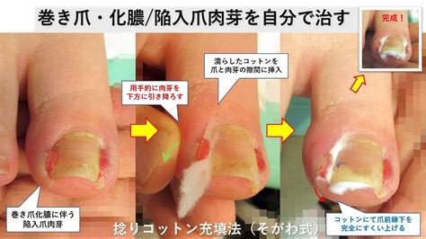 巻き爪化膿陥入爪肉芽を自分で治す治し方は YouTube