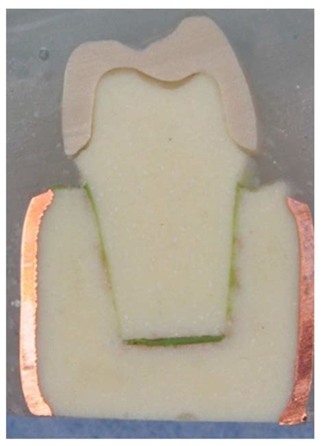The Pdl Substitute Is The Green Interface Between The Tooth Structure