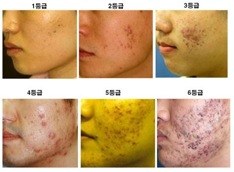한국형 여드름 등급 한국형 여드름 중증도 시스템 네이버 블로그