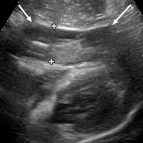Subxiphoid Ultrasound Scan Showing A Large Partially Hyperechoic Download Scientific Diagram