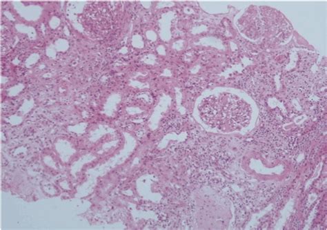 Crescentic Iga Nephropathy Following Bone Fracture