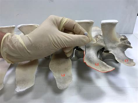 Paravertebral Block Proximal Approach In Cows Bovis Vetlexicon