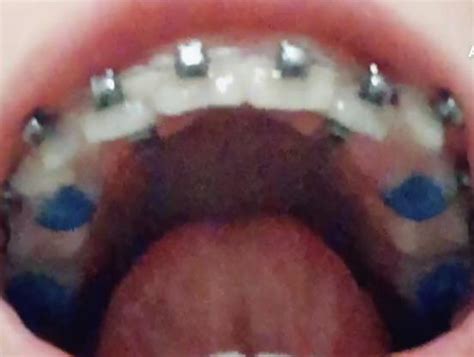 Is It Just Me Or Did Anyone Else Get This Many Bite Turbos R Braces