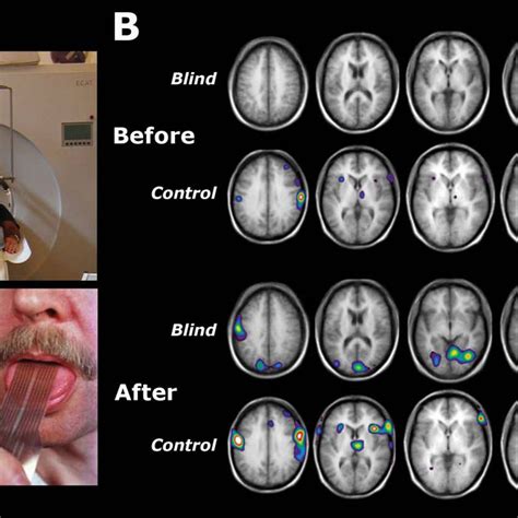 Pdf Cross Modal Plasticity In Early Blindness