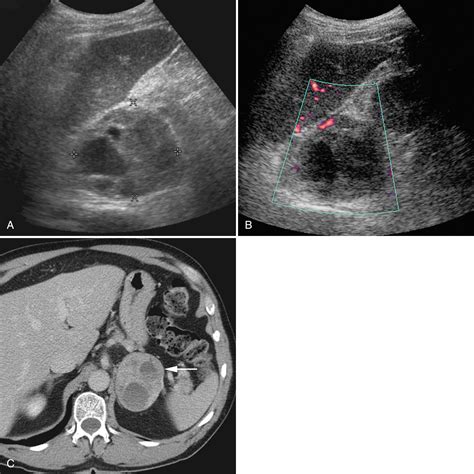 The Adrenal Glands Clinical Tree