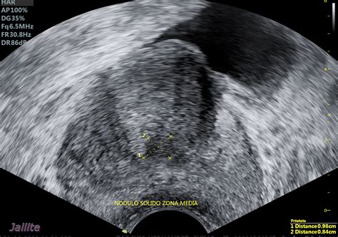 Hipertrofia Prost Tica