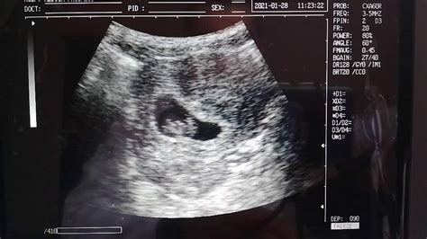 Cómo Se Ve Un Bebe De 8 Semanas Mibbmemima ️