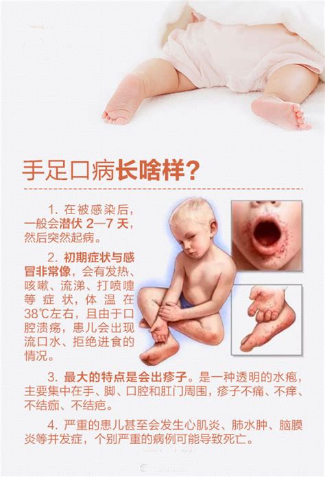 宝宝得了手足口病怎么治疗？大人会被传染么？