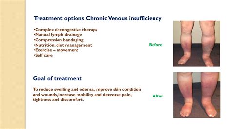 Ppt Lymphatic Massage Explant Surgery Powerpoint Presentation Free