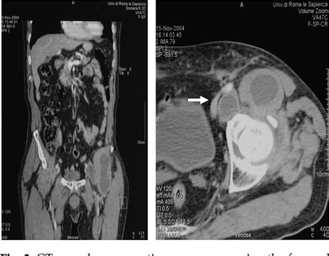 Figure 2 From An Unusual Case Of Synovial Cyst Of The Hip Joint Presenting As Femoral Vein