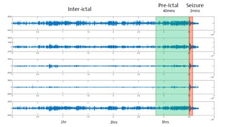 Mobile Epilepsy Predictive System 8292 Words Free Paper Example