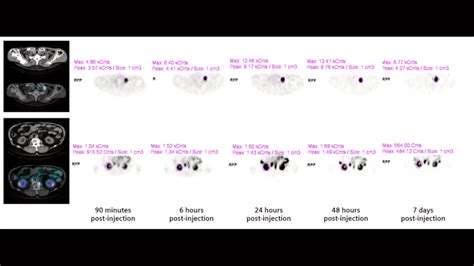 Tumor And Organ Dosimetry From Sequential Quantitative Spectct