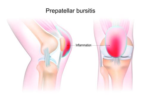 Pre Patellar Bursitis Knee Education