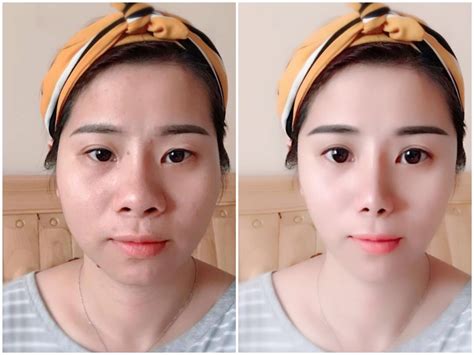 模拟太阳穴填充对比图脂肪填充太阳穴模拟整形模拟整容通app