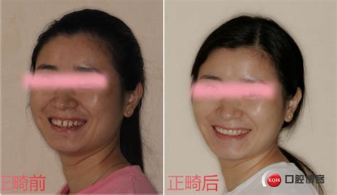 Top 9 牙齿缝隙，磨牙锁颌，隐形矫正 张世伟的博客 Kq88口腔博客