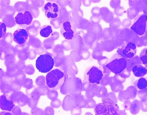 Basophilic Myelocyte