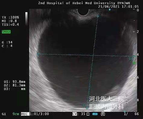 分享一例胰腺假性囊肿的ercp治疗胆胰内镜网