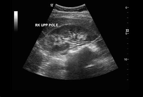 Renal Venous Infarct On Ultrasound Diagnostic Medical Sonography