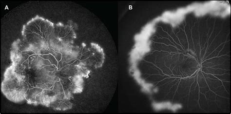 Multimodal Imaging Redefining Retinal Disease With Current Technology