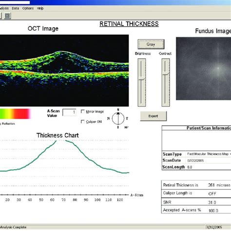 Screenshot Of Oct Macula Scan Results From Initial Visit July 22 2005 Download Scientific