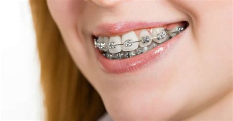 Aparelho ortodôntico pode deixar os dentes moles