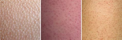 Фолликулярный гиперкератоз признаки причины симптомы лечение и профилактика Idoctor Kz