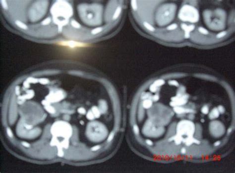 Abdominopelvic Contrast Enhanced Ct Scan Revealing The Right Renal
