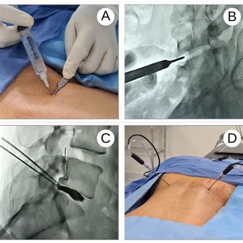 Surgical Approach For The Administration Of Intradiscal Radiofrequency Download Scientific