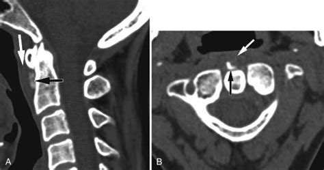 Longus Colli Tendinitis Radiology Key